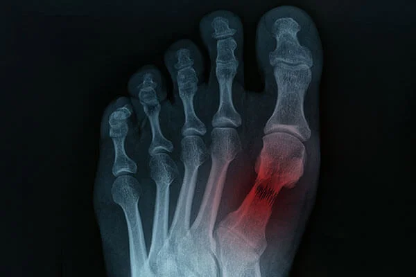 Xray Of Foot Stress Fracture 2nd Metatarsal Stress Fractures