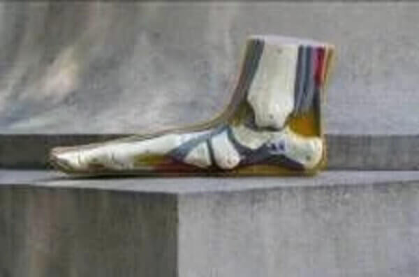 Flat Feet Treatment Melbourne | Melbourne Podiatrist