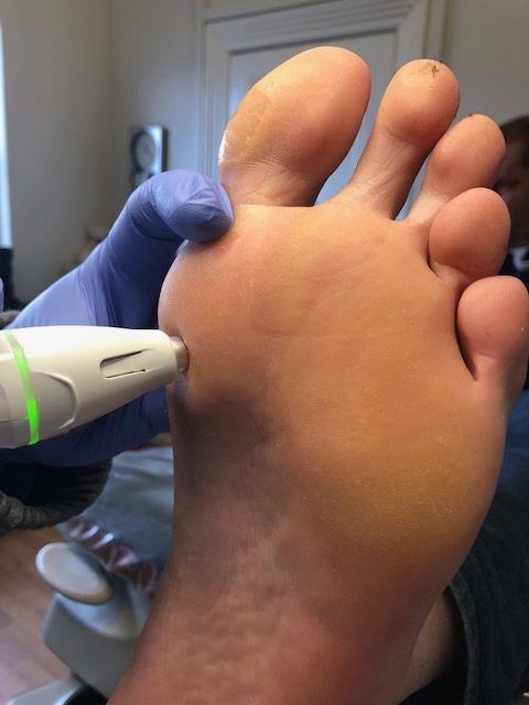SWIFT Plantar Wart Treatment Clifton Hill