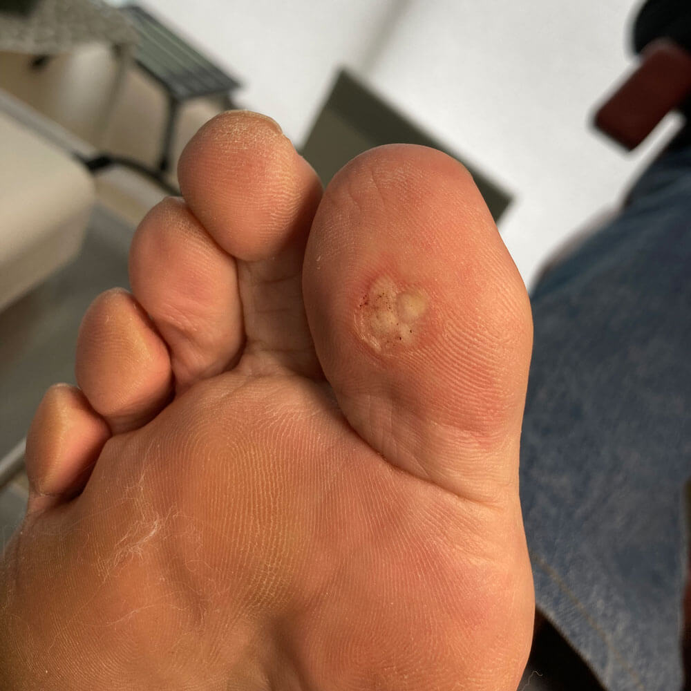 SWIFT Plantar Wart Treatment North Melbourne